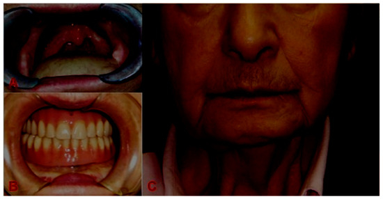 “Pull-through” Resection for Total and Subtotal Glossectomy Involving ...