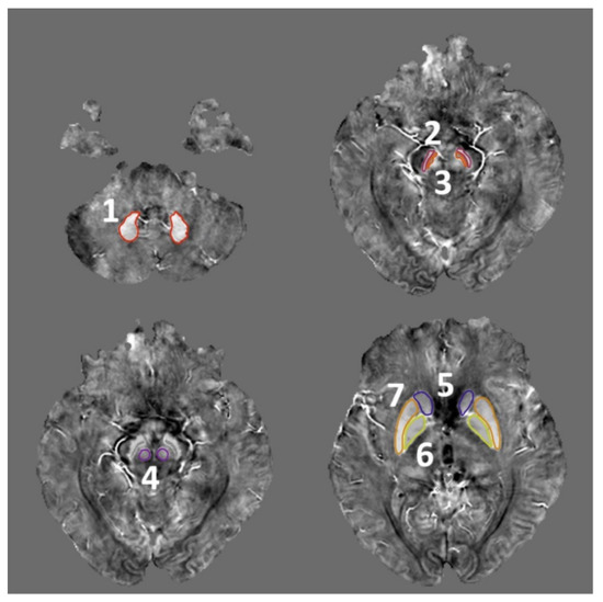 Screening Patients with Early Stage Parkinson’s Disease Using a Machine ...