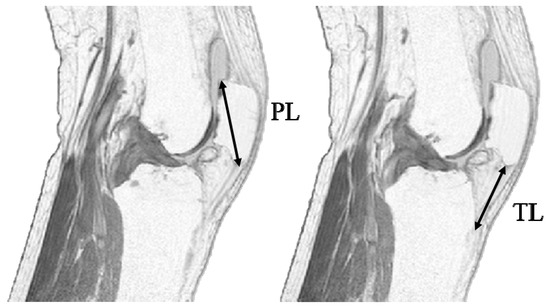Gender Differences in Patellar Positions among the Korean Population