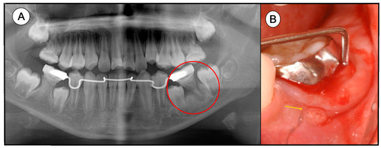 Complications of Teeth Affected by Molar-Incisor Malformation and ...