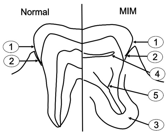 Complications of Teeth Affected by Molar-Incisor Malformation and ...