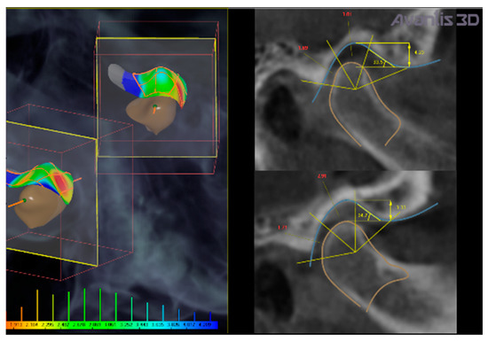 A Full Digital Workflow to Design and Mill a Splint for a Patient with ...