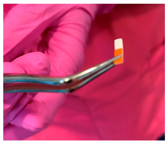 Evaluation of IL1β and IL6 Gingival Crevicular Fluid Levels during the ...