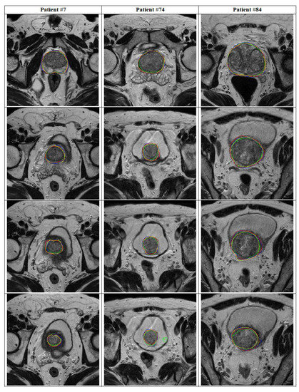Deep Learning-Based Methods for Prostate Segmentation in Magnetic ...