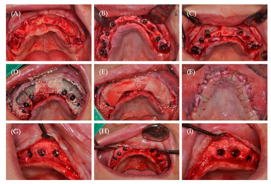 Retrospective Analysis of the Effect of Three-Dimensional Preformed ...