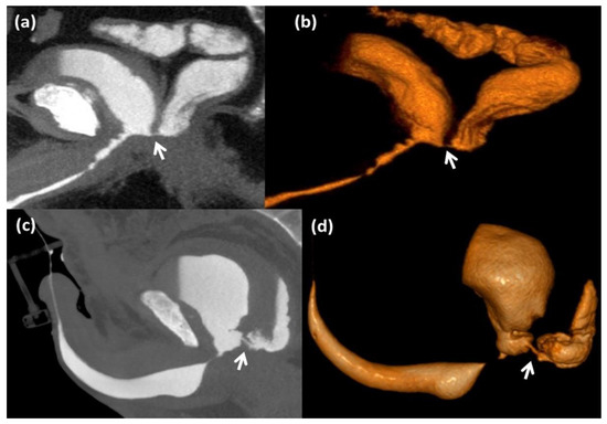 A New Technique for Computed-Tomography Urethrography in Males: The ...