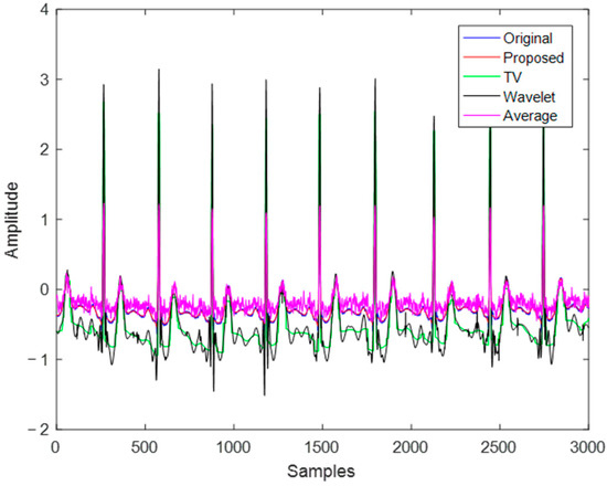 ECG Signal Denoising and Reconstruction Based on Basis Pursuit