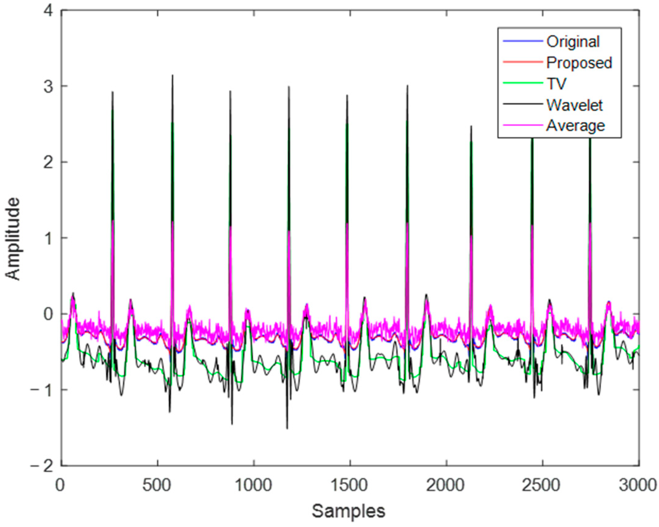 ECG Signal Denoising and Reconstruction Based on Basis Pursuit