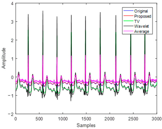 ECG Signal Denoising and Reconstruction Based on Basis Pursuit