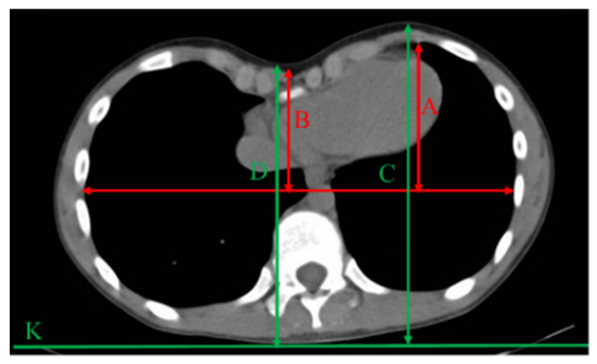 Handheld Optical System for Pectus Excavatum Assessment