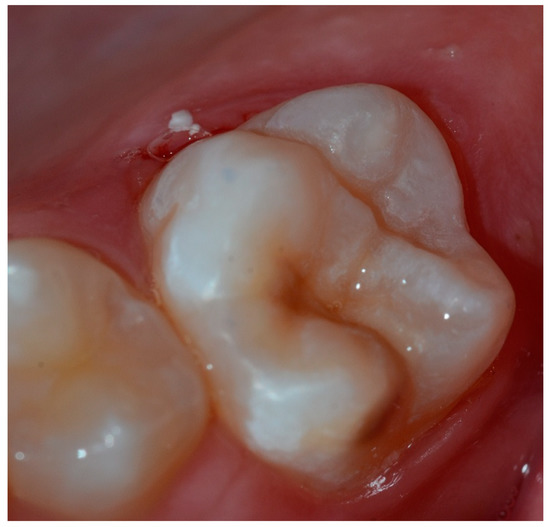 Hypersensitivity in Molar Incisor Hypomineralization: Superficial ...