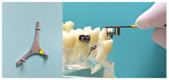 Prototype of Augmented Reality Technology for Orthodontic Bracket ...