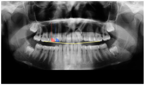 Correlation between Mesio-Distal Angulation and Bucco.-Lingual ...