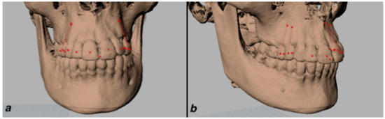 Correlation between Mesio-Distal Angulation and Bucco.-Lingual ...