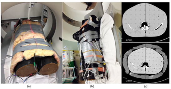 Low Radiation Dose Implications in Obese Abdominal Computed Tomography ...