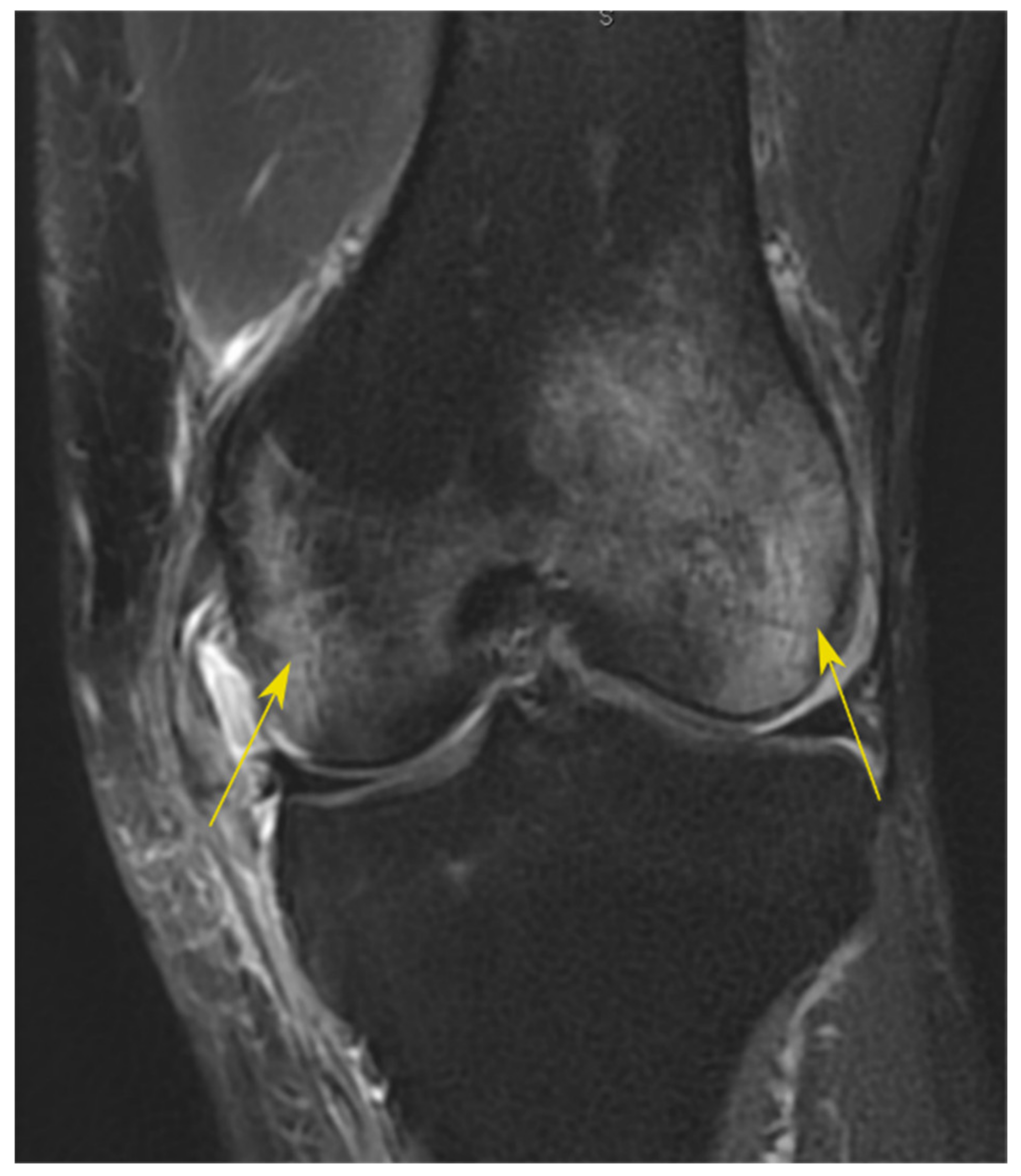 Bone Bruise Knee Mri
