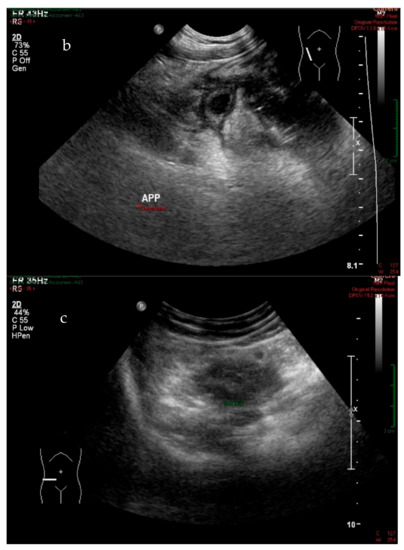 Evaluation of Ultrasound Accuracy in Acute Appendicitis Diagnosis