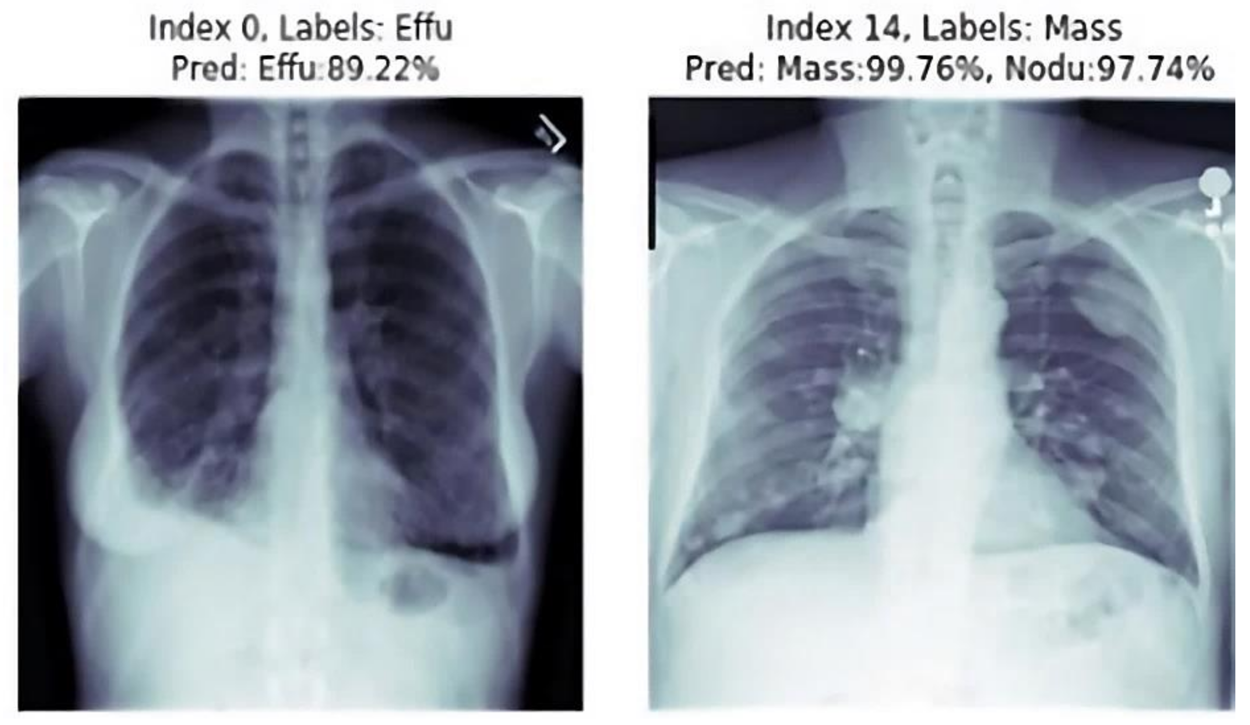 Healthy Lungs Vs Smokers Lungs X Ray
