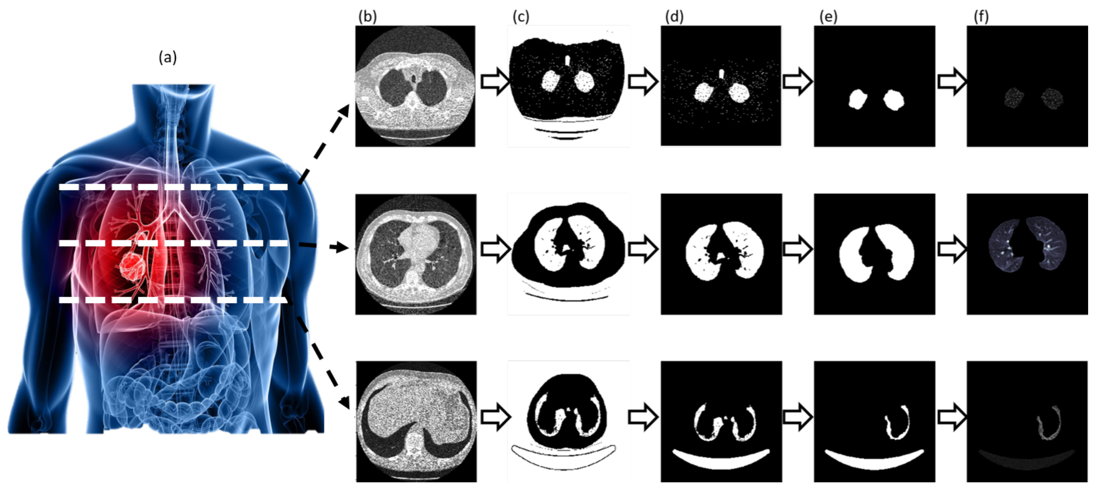 Nodule Detection with Convolutional Neural Network Using Apache Spark and GPU Frameworks