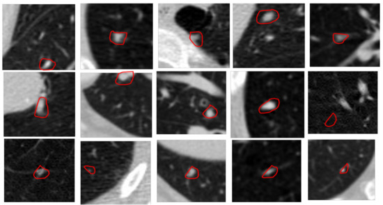 Nodule Detection with Convolutional Neural Network Using Apache Spark and GPU Frameworks