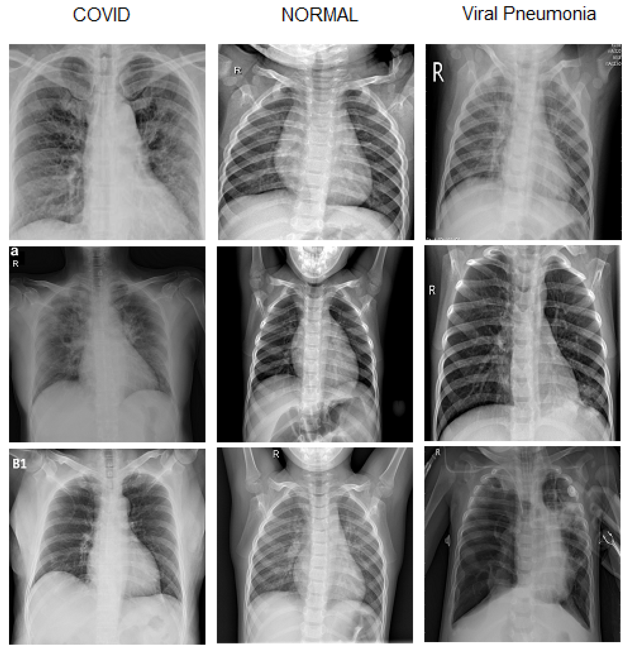 Applied Sciences | Free Full-Text | COVID-19 Diagnosis in Chest X-rays ...