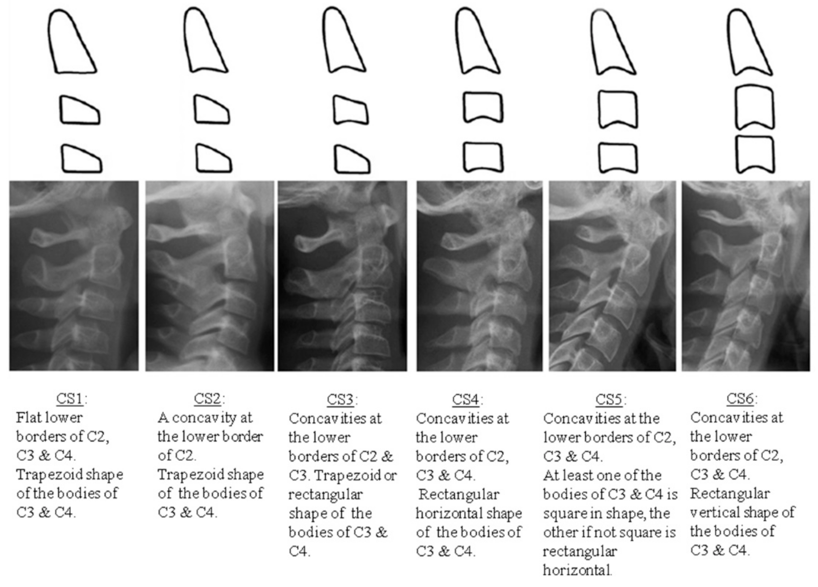 Cervical Vertebral Maturation Method Reproducibility And Efficiency Of