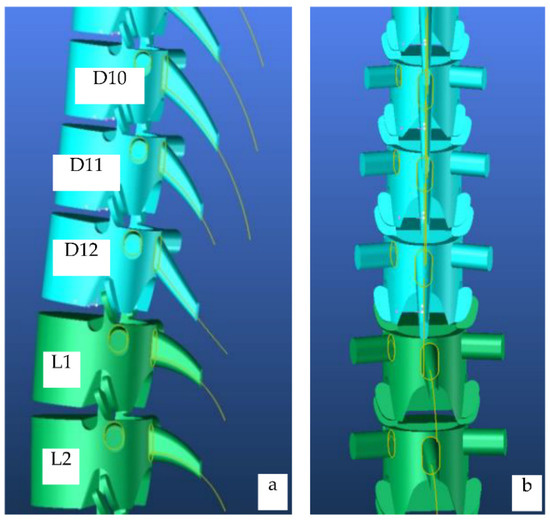 Developing an Adaptive 3D Vertebrae Model of Scoliosis Patients for ...