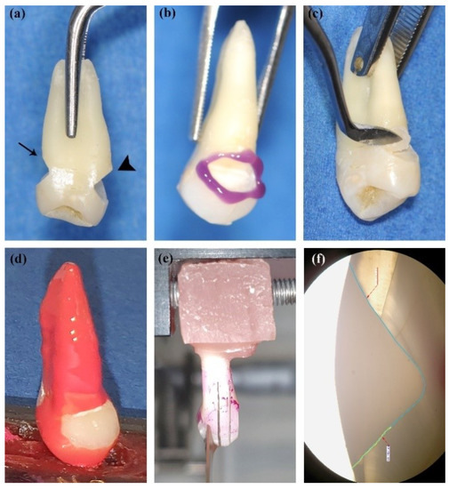 Adhesion of Flowable Resin Composites in Simulated Wedge-Shaped ...
