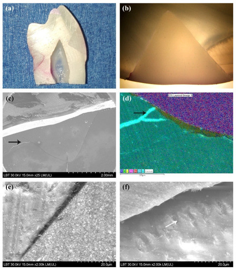 Adhesion of Flowable Resin Composites in Simulated Wedge-Shaped ...