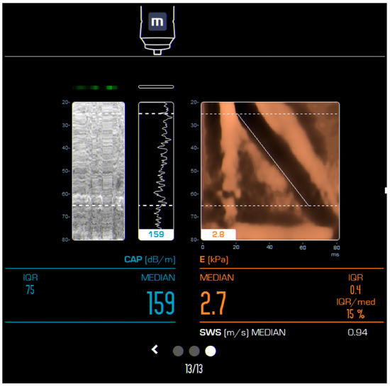 Elastography—A Bona Fide Non-Invasive Method for Assessing Non ...