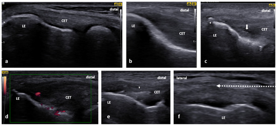 Ultrasound-Guided Procedures in Common Tendinopathies at the Elbow ...