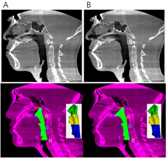 Deep Learning Based Airway Segmentation Using Key Point Prediction