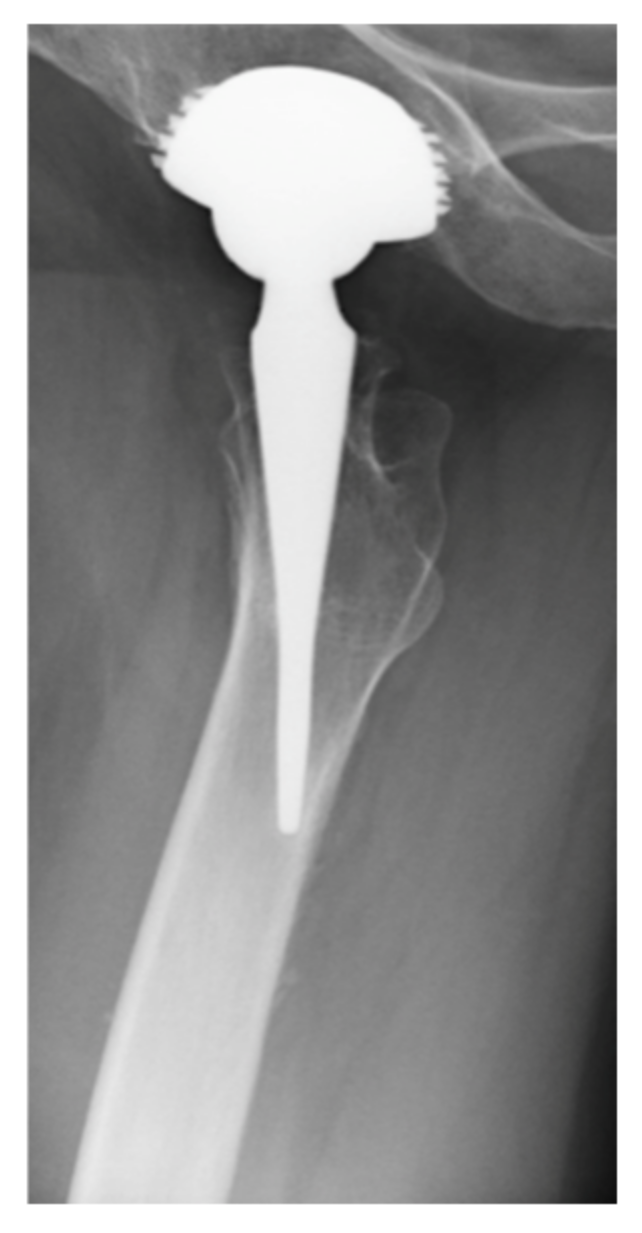The Rate of Correctly Planned Size of Digital Templating in Two Planes ...