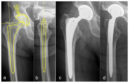 The Rate of Correctly Planned Size of Digital Templating in Two Planes ...