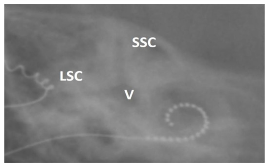 The Importance of Intraoperative Plain Radiographs during Cochlear ...