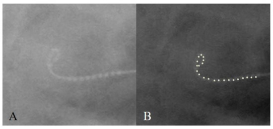 The Importance of Intraoperative Plain Radiographs during Cochlear ...