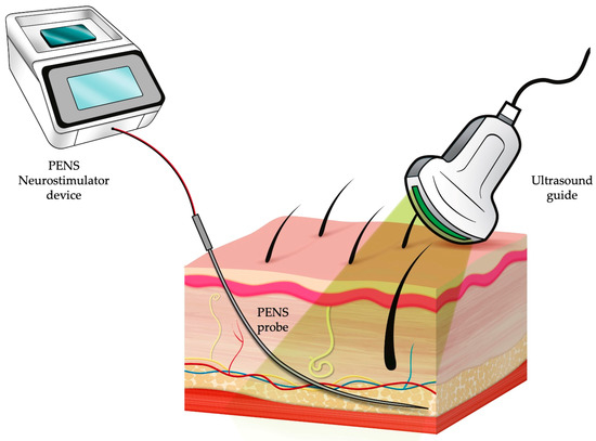 Percutaneous Electrical Nerve Stimulation (PENS) as a Rehabilitation Approach for Reducing Mixed ...