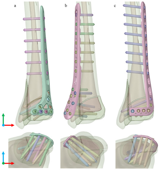 Biomechanical Comparison of a Novel Implant and Commercial Fixation ...