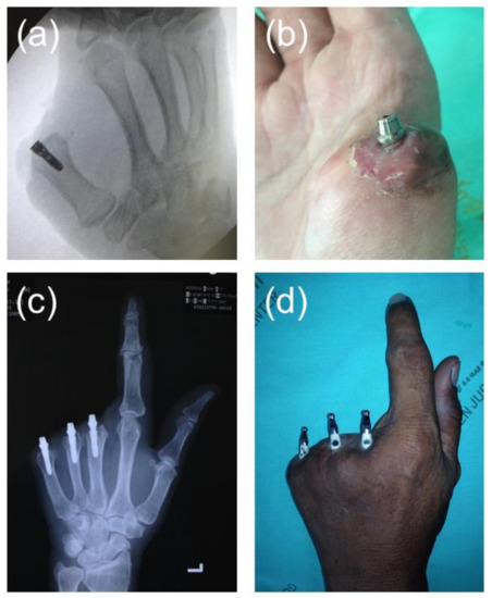 Recent Advances in Myoelectric Control for Finger Prostheses for ...