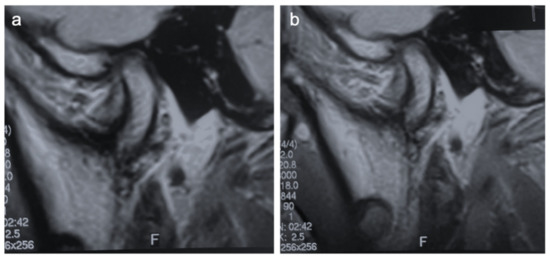 Mandibular Coronoid Process Hypertrophy: Diagnosis and 20-Year Follow ...