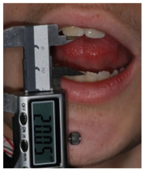 Mandibular Coronoid Process Hypertrophy: Diagnosis and 20-Year Follow ...