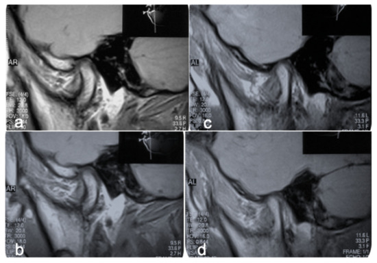 Mandibular Coronoid Process Hypertrophy: Diagnosis and 20-Year Follow ...