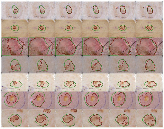 Skin Lesion Segmentation by U-Net with Adaptive Skip Connection and ...