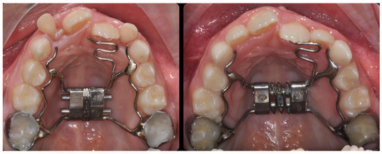 Early Treatment with a Slow Maxillary Ni–Ti Leaf Springs Expander