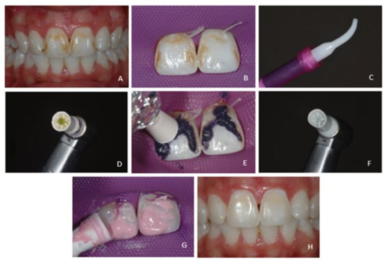 Minimally Invasive Dentistry for Pre-Eruptive Enamel Lesions—A Case Series