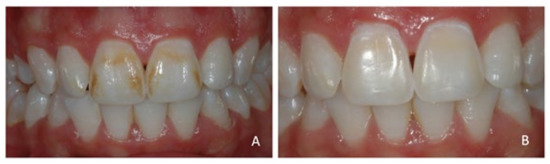Minimally Invasive Dentistry for Pre-Eruptive Enamel Lesions—A Case Series