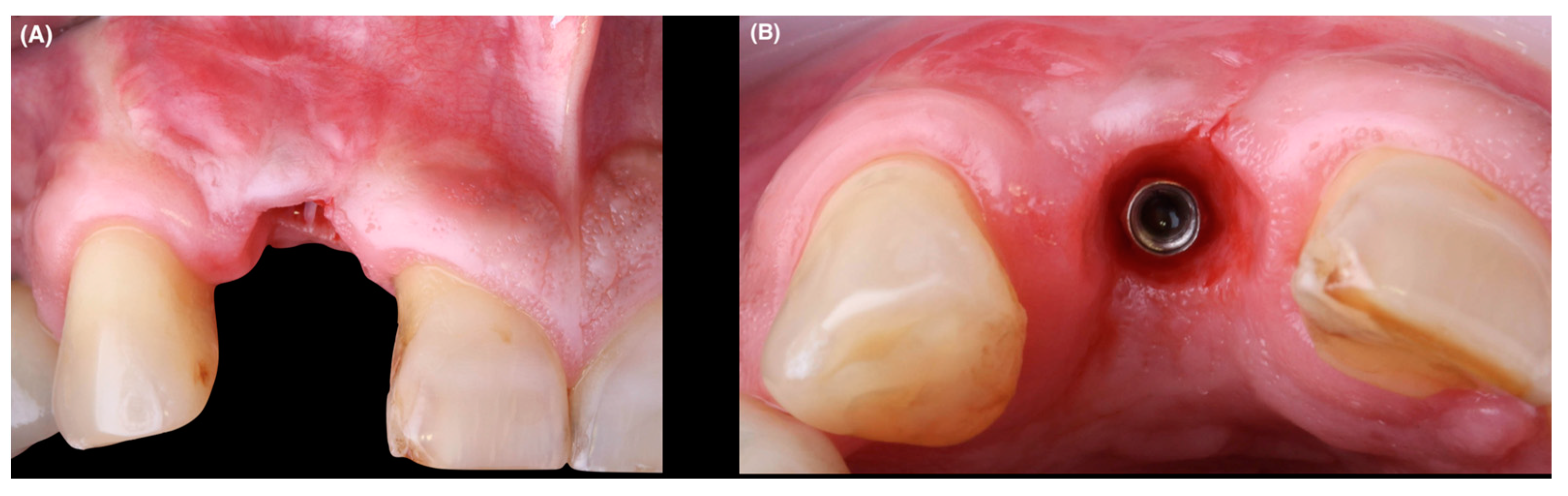 Clinical Outcome of a New Surgical Technique for the Treatment of Peri ...
