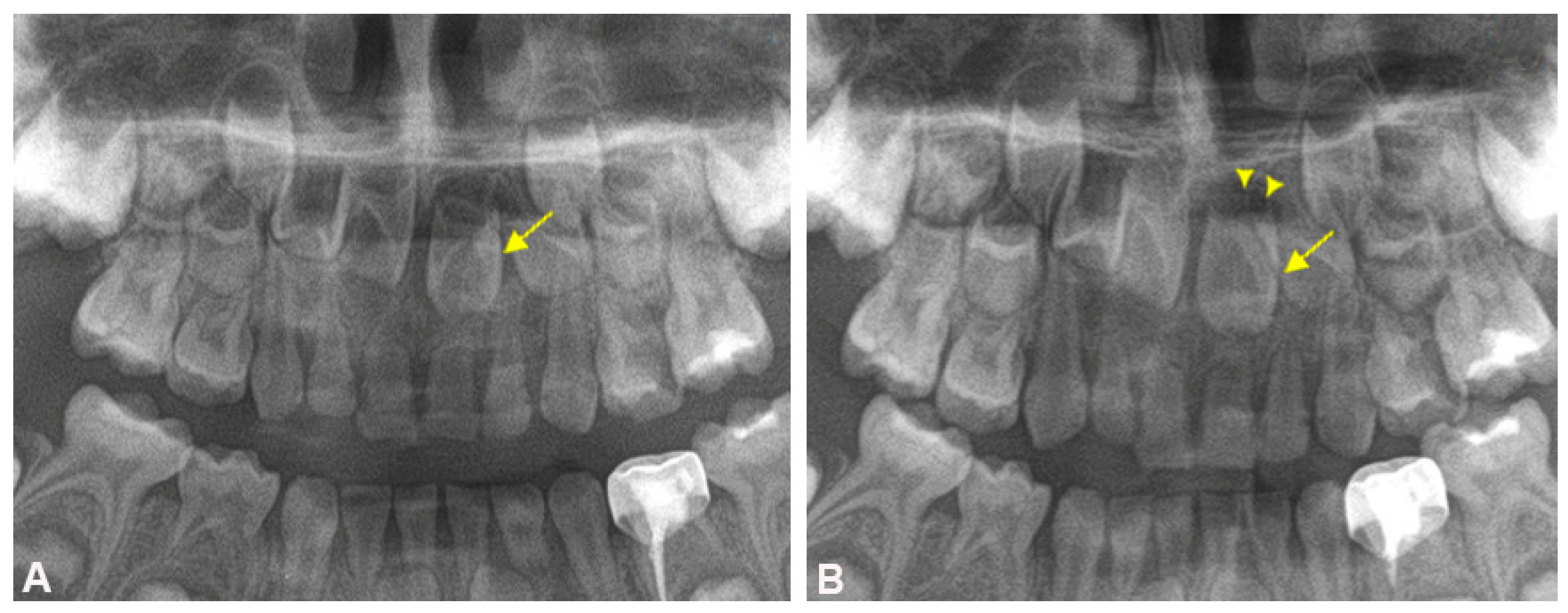 Surgical Repositioning of an Inverted Developing Incisor Assisted by 3D ...