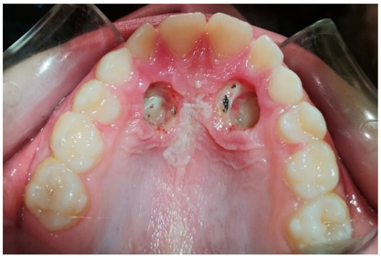 Disinclusion of Palatally Impacted Canines with Surgical and ...