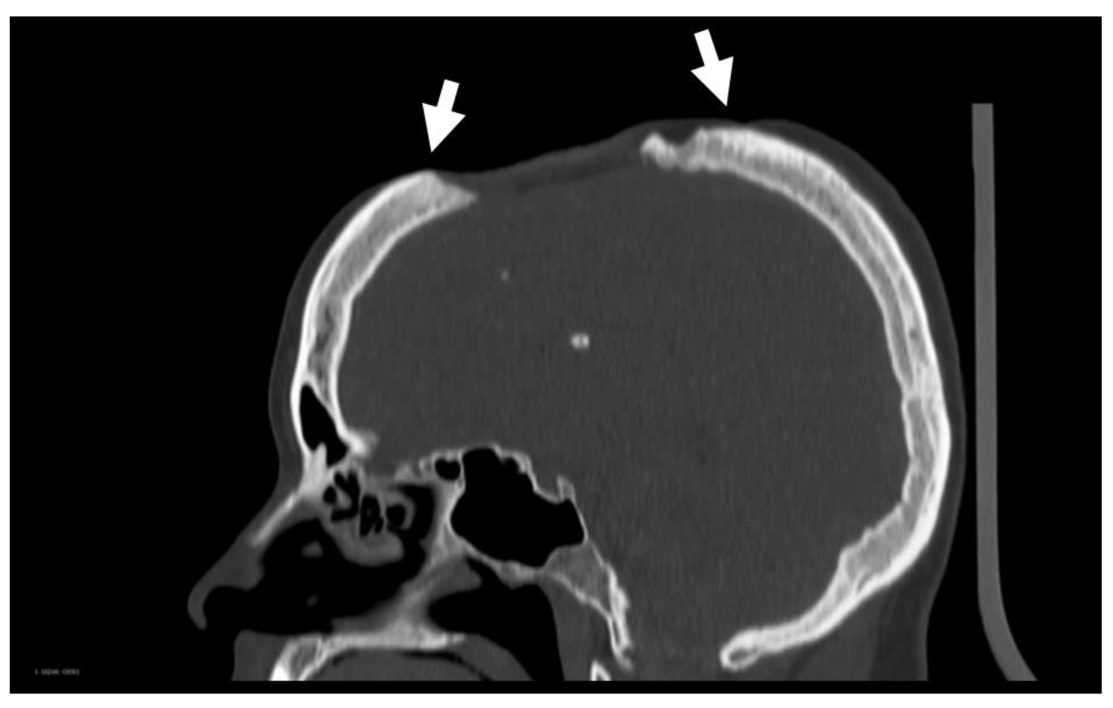 Additive Manufacturing and Reverse Engineering in Cranioplasty: A ...